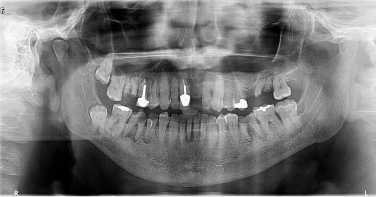 Radiographie panoramique – Radiographie dentaire • Tooth&Go